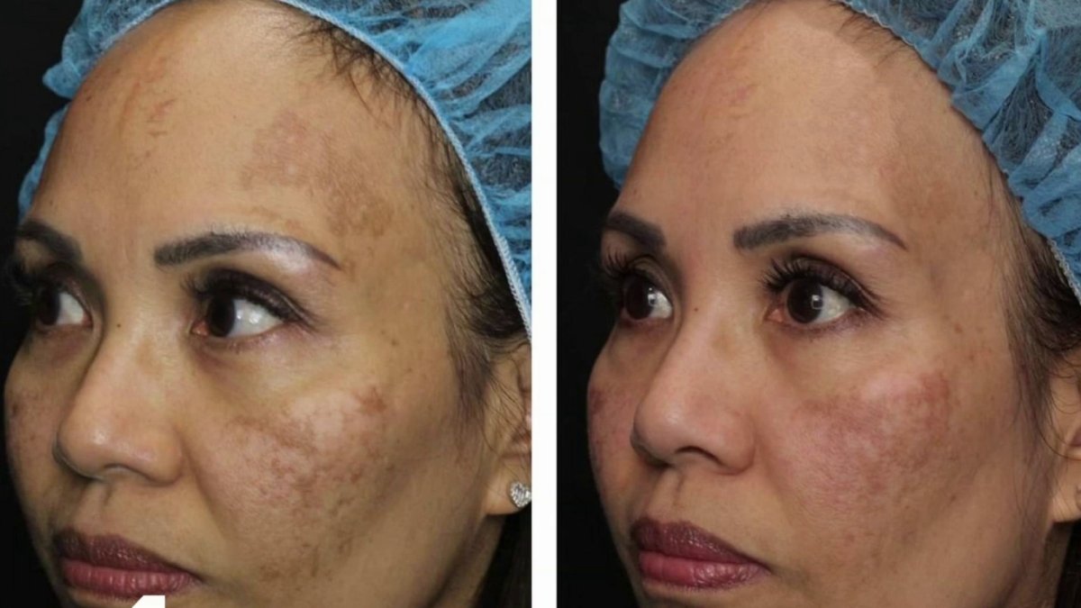 Say Goodbye to Brown Spots, Melasma With These Skin Care Tips – NBC Los ...