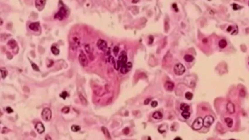 UC Irvine Records Case of Measles – NBC Los Angeles