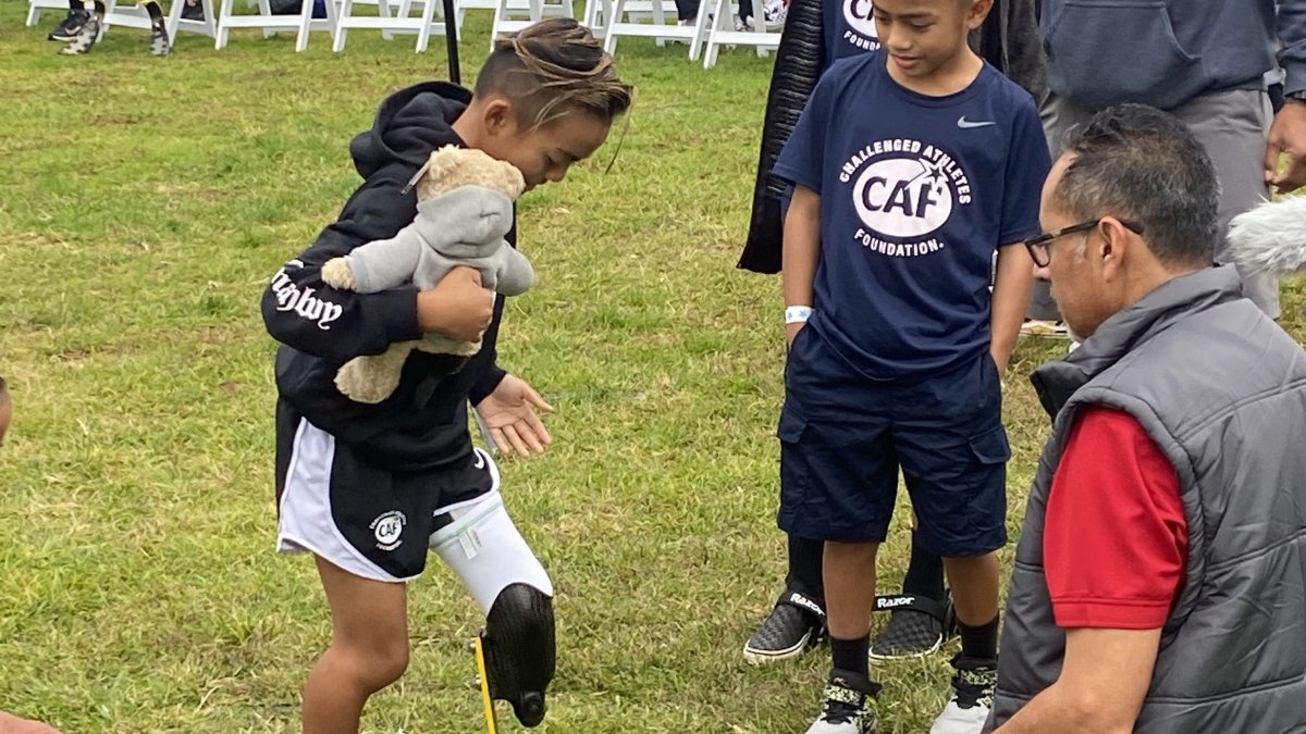 10-Year-Old Amputee from Chula Vista Celebrates Getting New Prosthetic ...