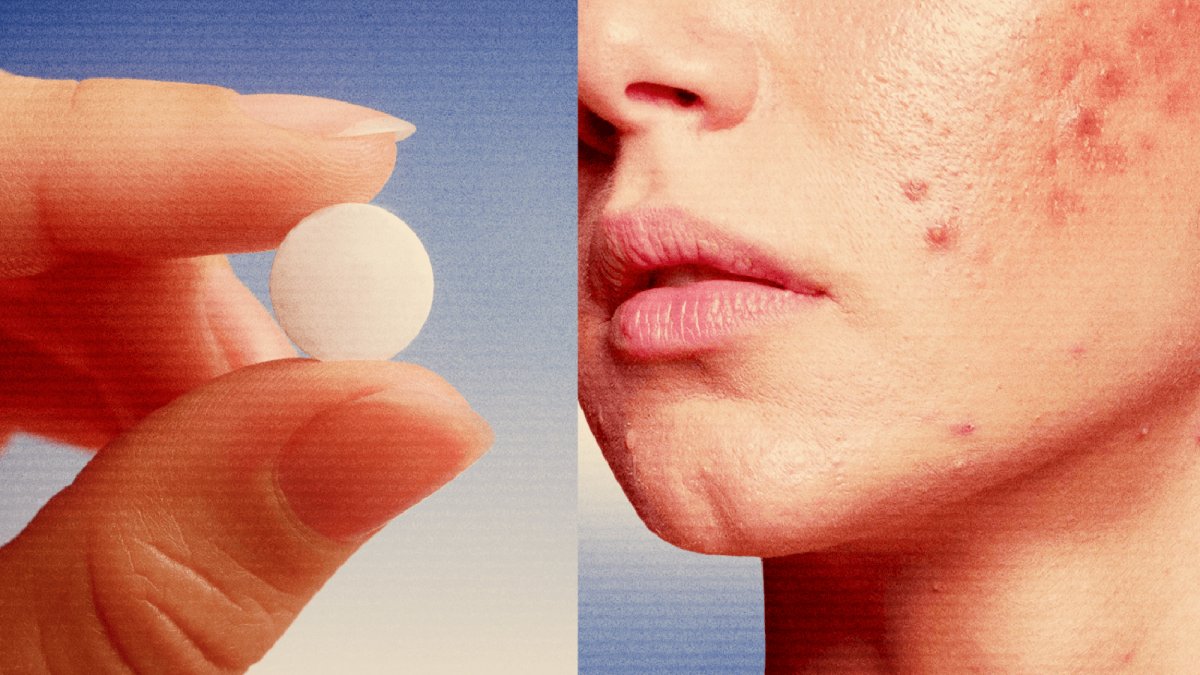 The most popular pill to treat women’s acne is a blood pressure drug ...