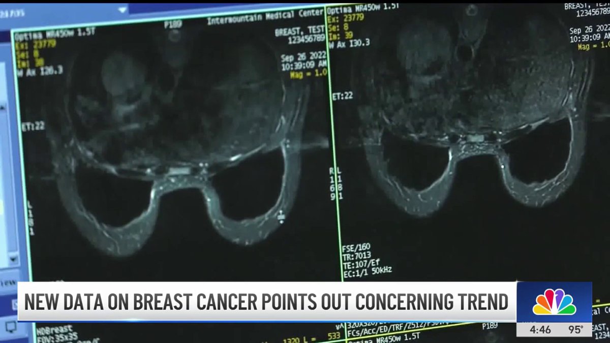 New data on breast cancer points out concerning trend – NBC Los Angeles