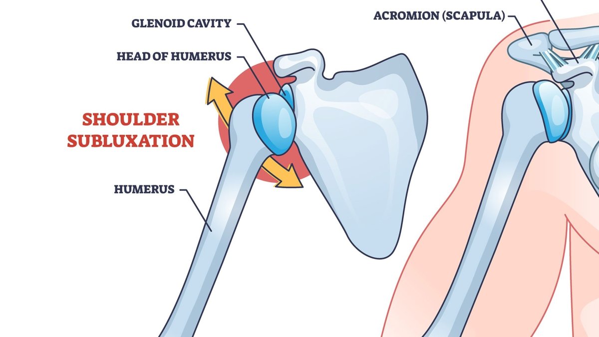 What is a shoulder subluxation? – NBC Los Angeles