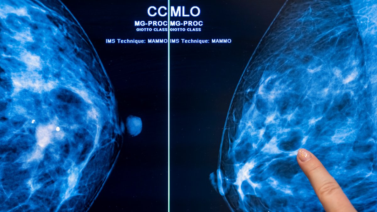 Study reveals how fat cells can fuel breast cancer tumors – NBC Los Angeles