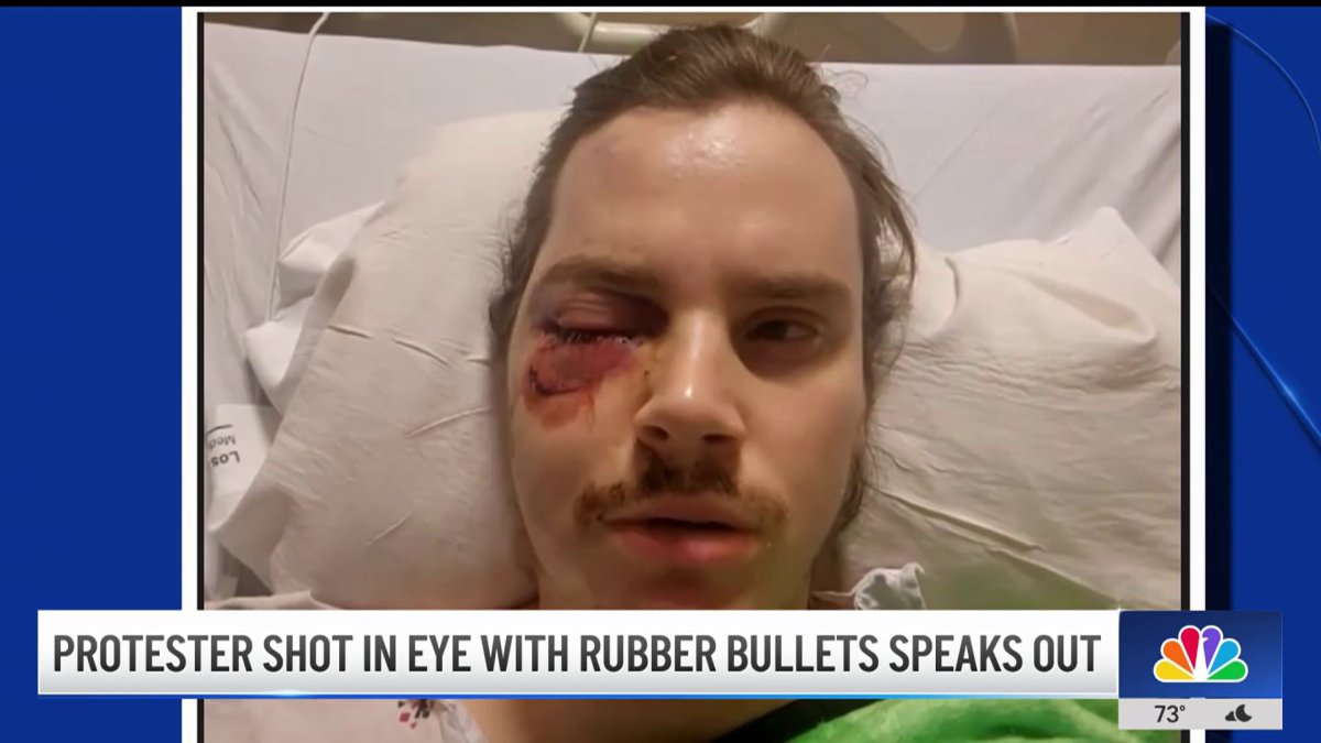 Photographer shot in the eye with rubber bullet at LA protest – NBC Los ...