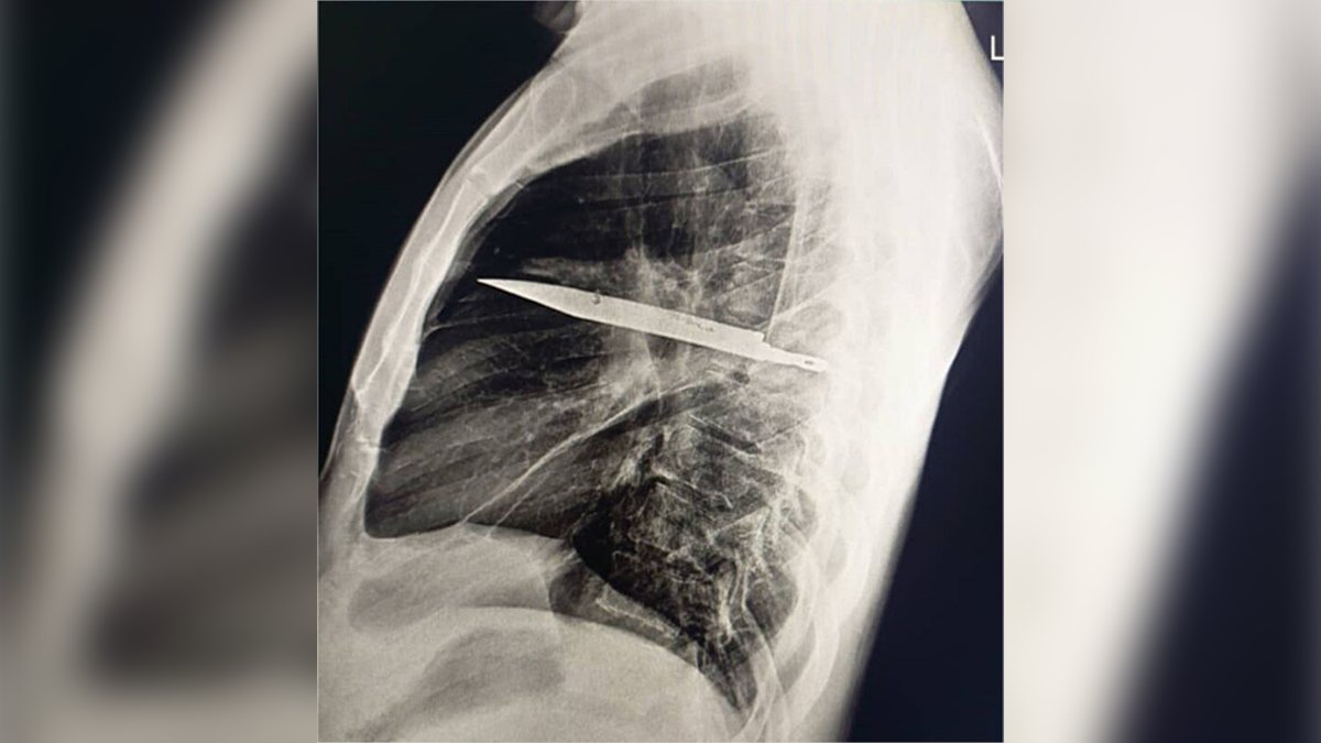 Doctors find knife embedded in man’s chest that was leaking pus – NBC ...