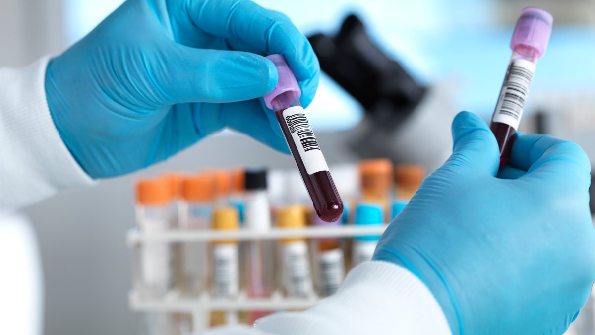 This blood test may predict heart disease better. – NBC Los Angeles